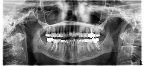 Looks Like Pano Day Dentist Said My Wisdom Teeth Are Textbook Worthy