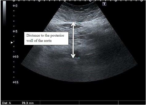 Abdominal Ultrasound Of 62 Female Patient Showing A The Preperitoneal