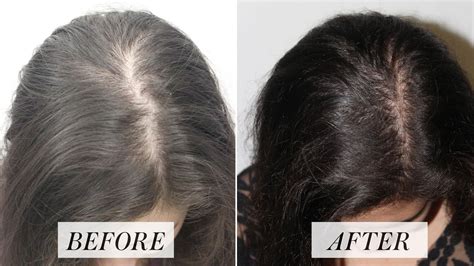Platelet Rich Plasma Treatment For Hair Loss Heres What To Know Allure