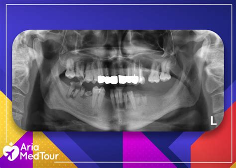 Dental Opg Complete Guide To Panoramic X Rays For Dentistry