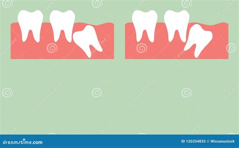 Type Of Wisdom Tooth Mesial Impaction Distal Impaction Horizontal