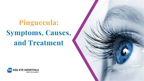 Pinguecula Causes Symptoms And Treatment
