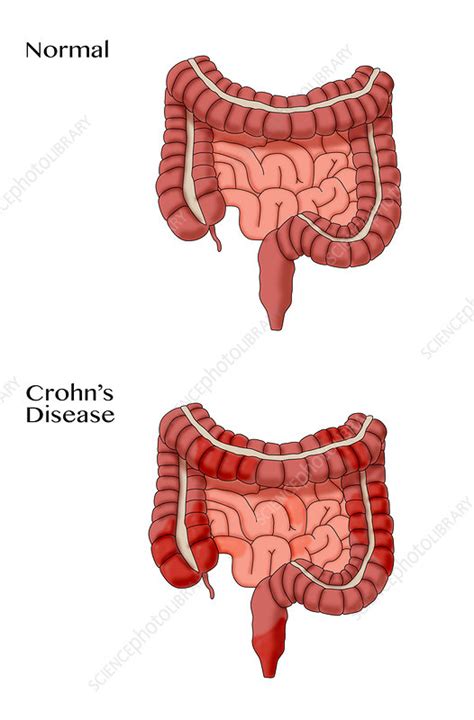 Normal And Crohns Disease Illustration Stock Image C036 5931