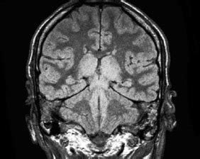 A Fatal Encephalitis The Lancet
