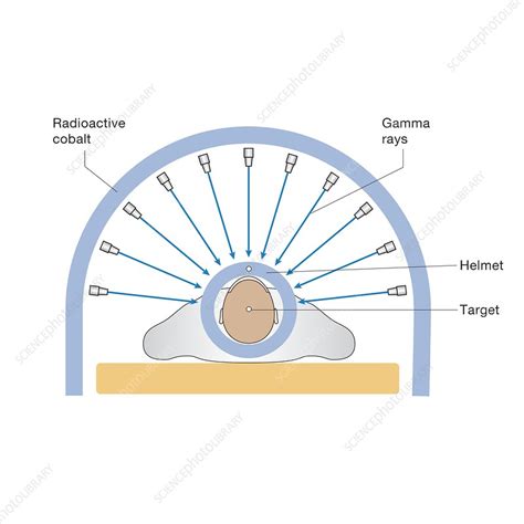 Radiation Therapy Diagram