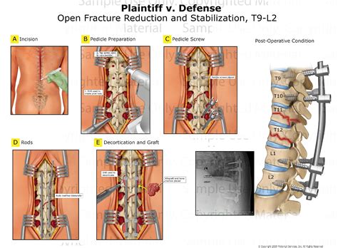 Thoracic Orif Motionlit