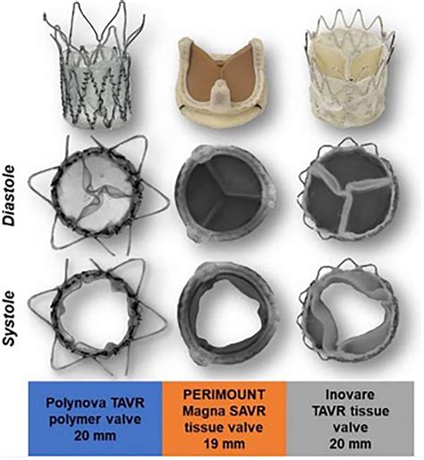 Different Types Of Tavr Valves At Lyn Romano Blog