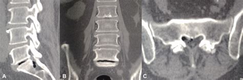 Epidural Gas Pseudocyst An Uncommon Cause Of Sciatica Abstract