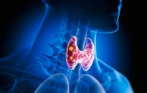 Hyperthyroïdie Thyroïde Hyperactive Symptômes Et Causes