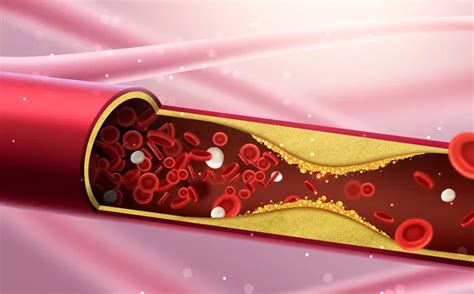 Mild Hyperlipidemia Symptoms Causes And Treatment