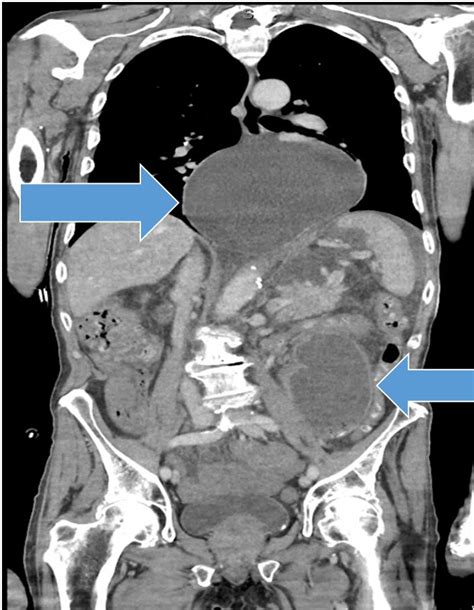 Gastric Volvulus Ct 2 Annotated Jetem 2019 Jetem