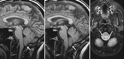 Cerebellar Tonsillar Ectopia Springerlink