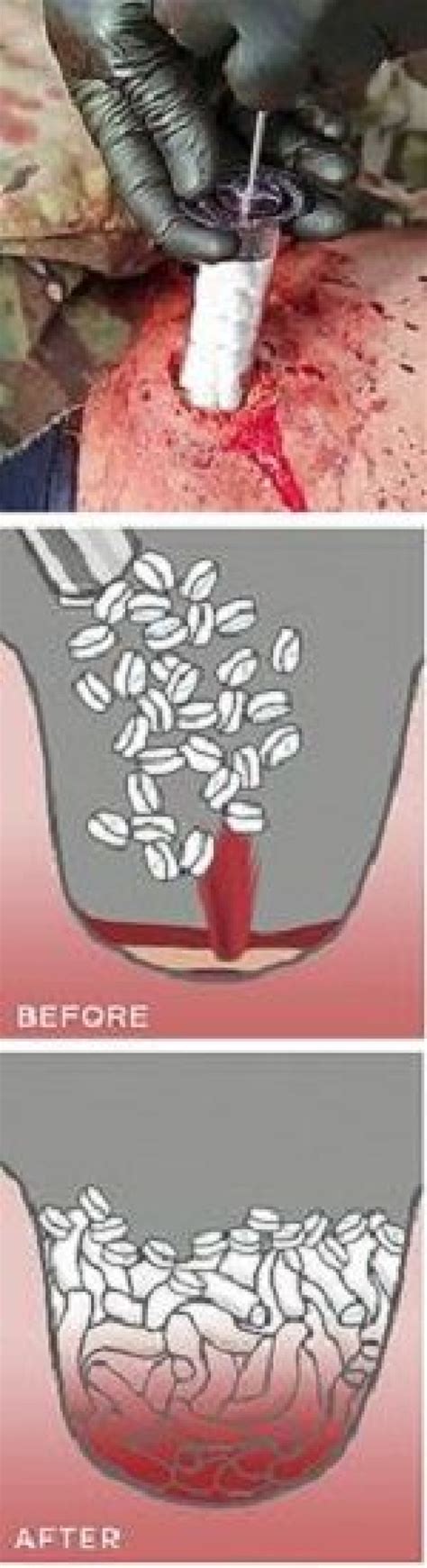 Xstat Device Plugs Gunshot Wounds With Sponges Stops Bleeding In 15