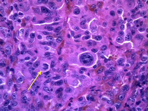 Higher Power View Showing Cellular Atypia With Enlarged Nuclei And