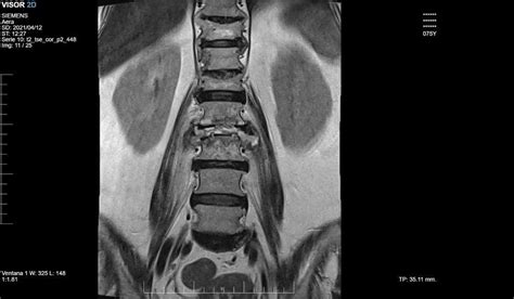 Espondilodiscitis Diagnóstico Y Manejo