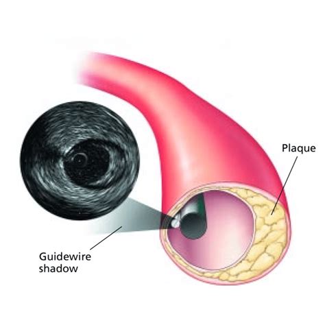 Ivus And Rotablator Cardiologist Led Artery Blockage Care