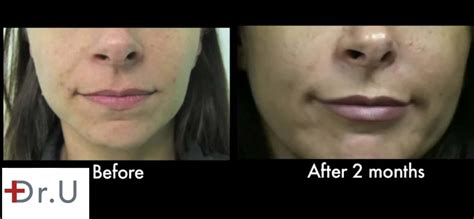 Video Westlake Village Patient Results For Laugh Lines Filler