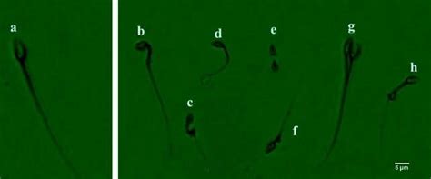 Sperm Morphology Using Diff Quik Sperm With Normal A And Abnormal