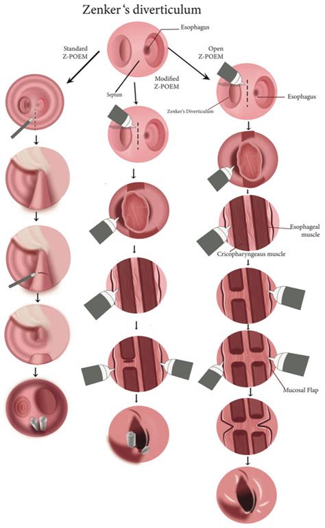 Management Strategies For Zenkers Diverticulum A Comprehensive Review