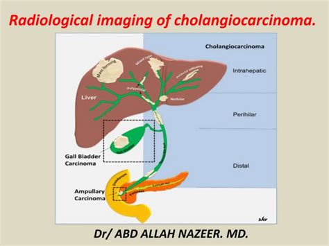 Cholangiocarcinoma Type
