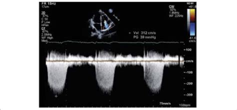 Determination Of Estimated Pulmonary Artery Systolic Pressure Using Download Scientific