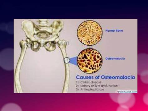 Osteomalacia Pptx