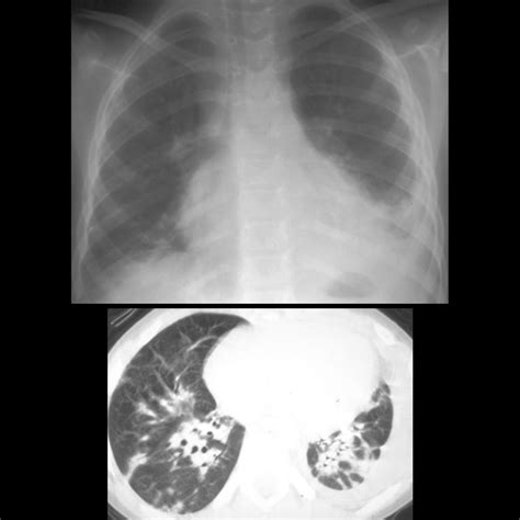 Pediatric Bronchiolitis Obliterans Pediatric Radiology Reference Article Pediatric Imaging