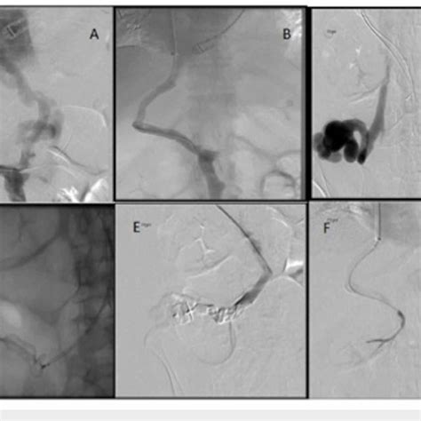Invasive Angiography Deployment Of Tipss And Embolization Of The