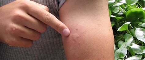 How To Treat An Insect Bite Radish Health