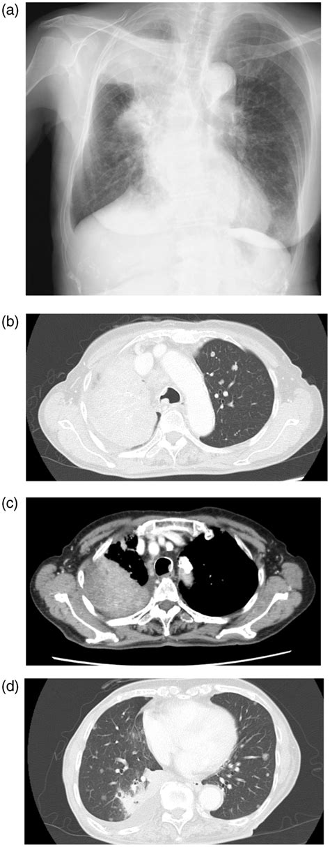 A Chest X‐ray And B C D Contrast‐enhanced Computed Tomography