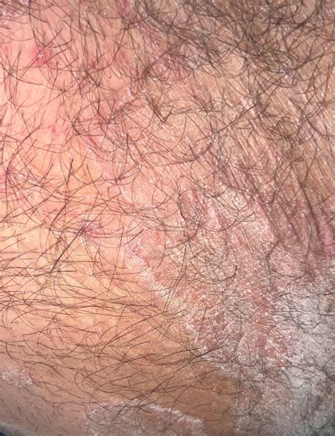 Terrible Jock Itch And Ringworm Over My Inner Thighs I Am Seriously