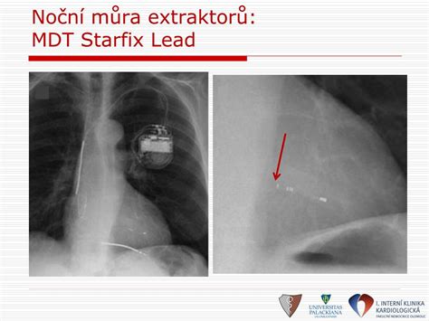 Ppt Techniques Safety And Complications Of Left Ventricular Lead