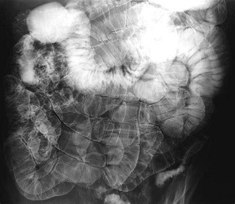 Hello Usa Enteroclysis