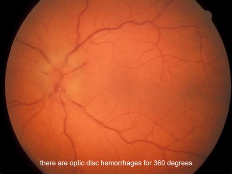 Optic Disc Hemorrhage Coms Grading