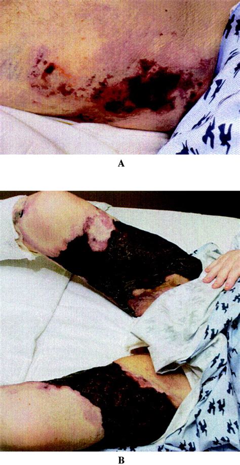 Calciphylaxis An Important Imitator Of Cutaneous Vasculitis Jacobs