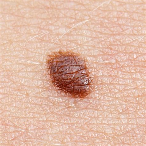 Basal Cell Carcinoma Signs Diagnosis And Treatment Options