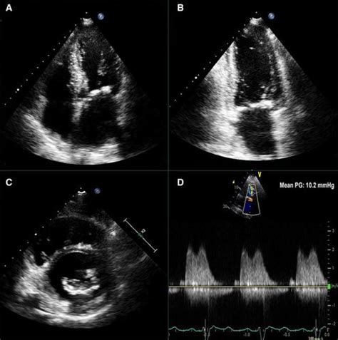 Degenerative Mitral Stenosis Circulation