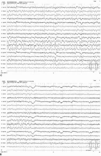 Benign Eeg Patterns Neupsy Key