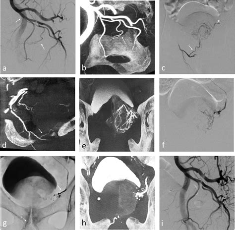 Repeat Prostatic Artery Embolization With The Addition Of A Liquid