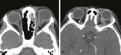 Anatomy Orbital Cellulitis