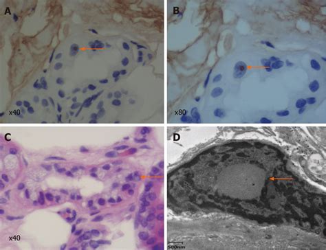 Skin Biopsy Specimen A And B Immunohistochemical Staining Showed That
