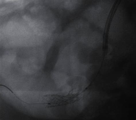 Dsa After Deployment Of Endovascular Stent Download Scientific Diagram