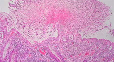 On Biology Could Fecal Transplants Be The Way Forward For Treating C Difficile Infection