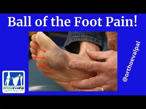 Ball Of Foot Problems Symptoms Learn More About Metatarsalgia Symptoms