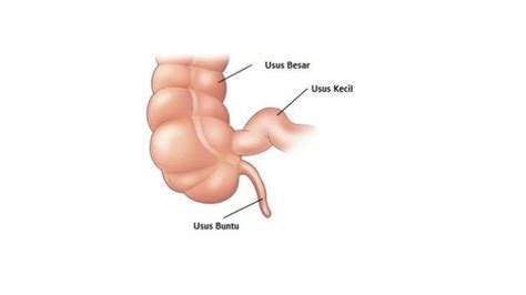 Mengenal Penyebab Dan Gejala Dari Usus Buntu Appendicitis