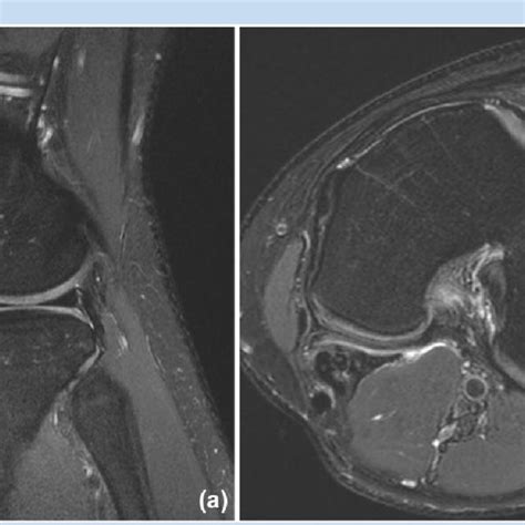 Microfracture Case Demonstrating A A Condylar Cartilage Defect That