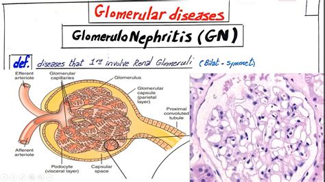 Renal Pathology 1st Lecture Glomerular Diseases Youtube
