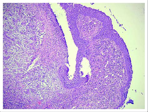 Histological Sections Case 2 Showing A Polypoid Nodule Consisting Of