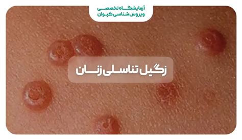 همه چیز درباره زگیل تناسلی زنان؛ علائم، پیشگیری و درمان عکس