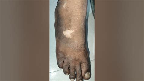 Leucoderma White Spots Leucoderma Whitespots Youtube